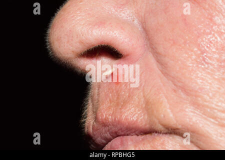 Inflamed sebaceous gland with sebum Stock Photo - Alamy