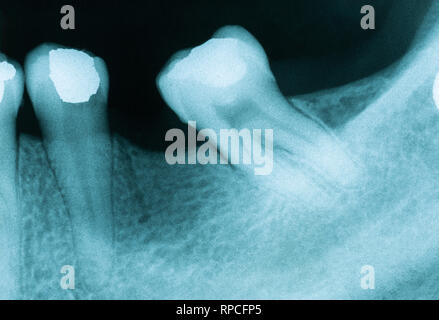 TOOTH DECAY, X-RAY Stock Photo: 48385934 - Alamy