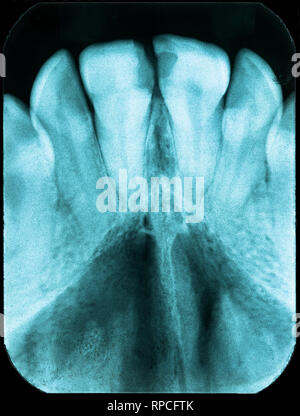TOOTH DECAY, X-RAY Stock Photo: 49179032 - Alamy