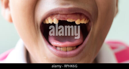 Little boy show Broken teeth.boy with a broken and rotten teeth Stock ...