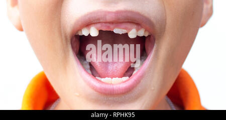 Little boy show Broken teeth.boy with a broken and rotten teeth Stock ...