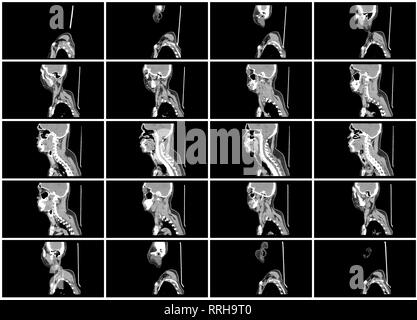 ct scan step set of neck coronal view Stock Photo - Alamy
