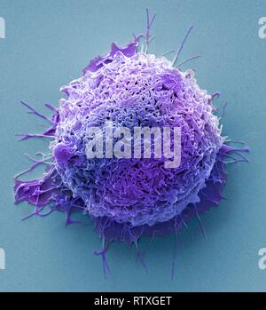 Colorectal cancer cell. Coloured scanning electron micrograph (SEM) of ...
