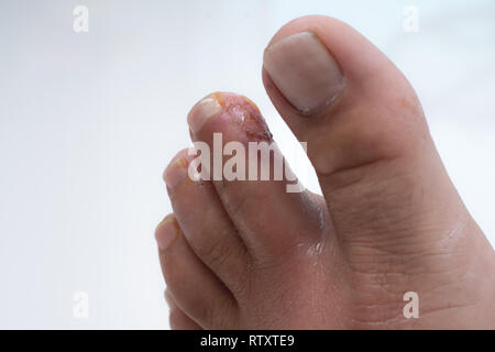Finger on the leg. Purulent wound on the leg. Eczema. Dermatitis ...
