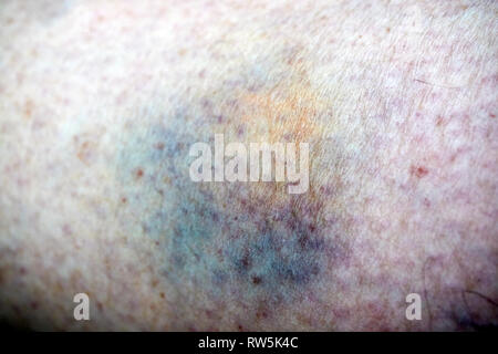 different colours of a bruise on a mans leg Stock Photo - Alamy