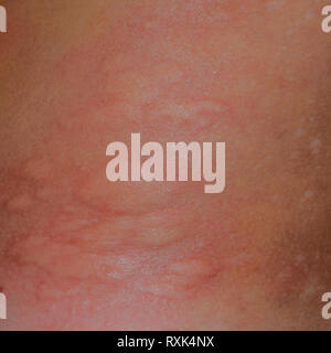 Allergy skin back and sides. Allergic reactions on the skin in the form ...