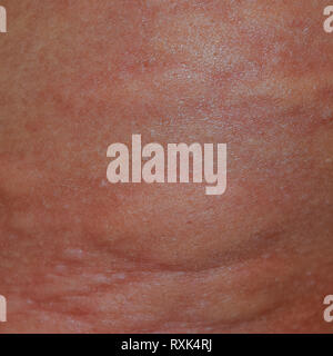 Allergy skin back and sides. Allergic reactions on the skin in the form ...