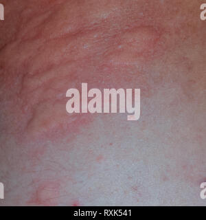 Allergy skin back and sides. Allergic reactions on the skin in the form ...