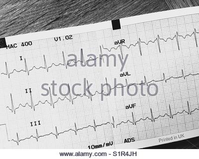 ECG print out Stock Photo: 40035587 - Alamy