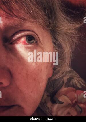 Subconjunctival hemorrhage (broken blood vessel in eye Stock Photo - Alamy