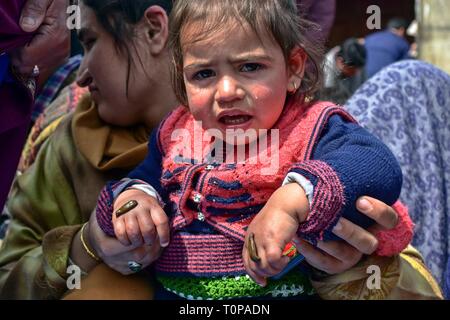 A young patient seen with leeches on her foot during the leech therapy ...