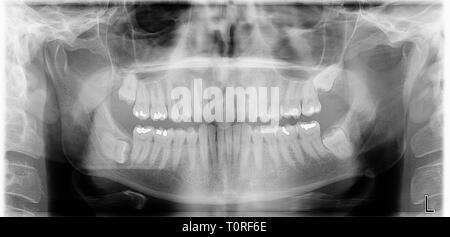 teeth panoramic xray Stock Photo - Alamy
