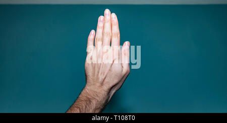 Shot of a white caucasian manâ€™s left hand with a broken pinky finger ...
