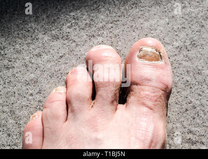 Ugly male feet and toes affected by toe nail fungus and arhtritic ...