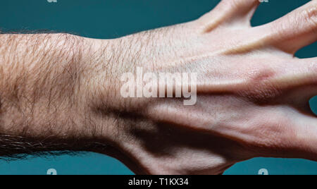 Ganglion cyst. Close-up of a ganglion cyst on the wrist of a 90-year ...
