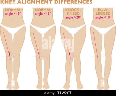 valgus, varus knee, legs disease, foot illustration Stock Vector Image & Art - Alamy