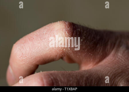 Dry Skin close up. Knuckles with scaling dry skin damage. Eczema dry ...