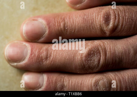 Dry Skin close up. Knuckles with scaling dry skin damage. Eczema dry ...