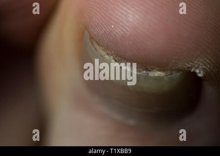 Fungal infection nail matrix. Toenail damage fungal trauma. Bacterial ...