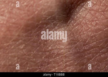 Dry Skin close up. Knuckles with scaling dry skin damage. Eczema dry ...