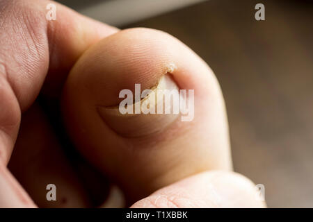 Fungal infection nail matrix. Toenail damage fungal trauma. Bacterial ...