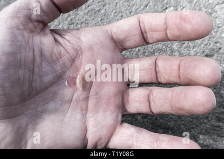 Hand palm with a blister Stock Photo - Alamy