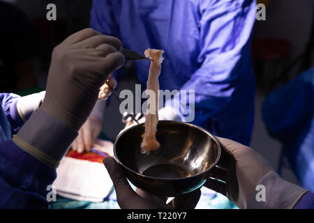 Surgeon putting a bit of human flesh in a bowl with his assistant next ...