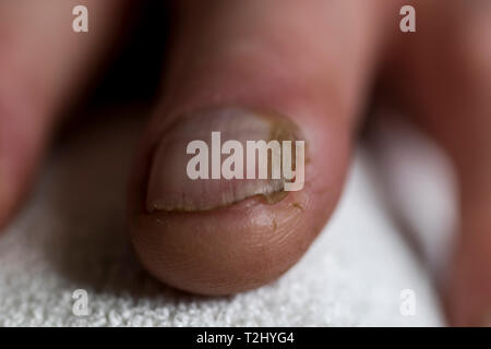 Fungal infection nail matrix. Toenail damage fungal trauma. Bacterial ...