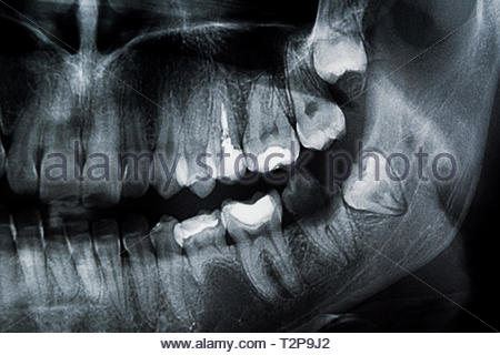 WISDOM TOOTH, X RAY Stock Photo - Alamy