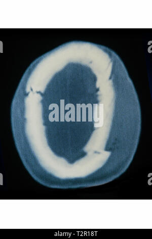 Skull fracture, CT scan Stock Photo - Alamy