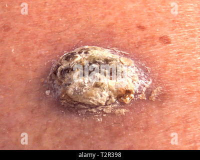Nodular basal cell carcinoma Stock Photo - Alamy