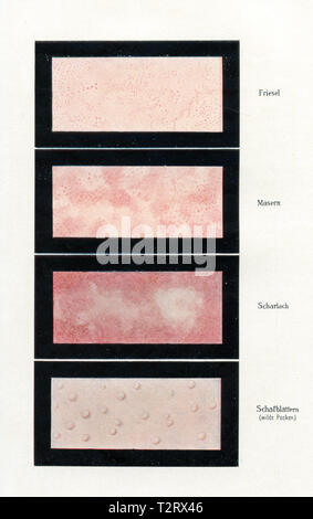 Skin appearance of scarlet fever, 1900 Stock Photo - Alamy