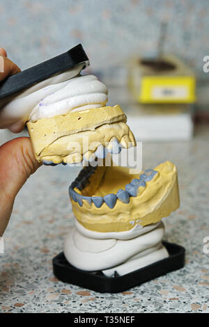 Plaster impressions of the teeth of the lower a jaw for prosthetics and ...
