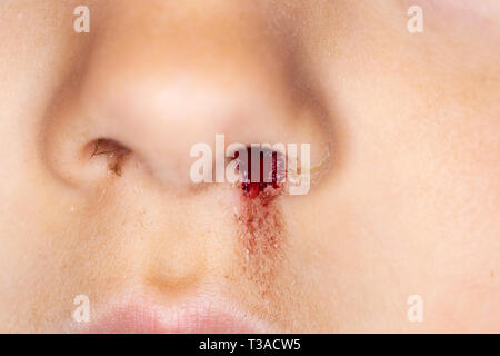 CHILD WITH NOSEBLEED Stock Photo - Alamy