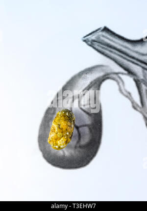 Gall bladder stone, schematic depiction, large-sized Gallstone, Result ...
