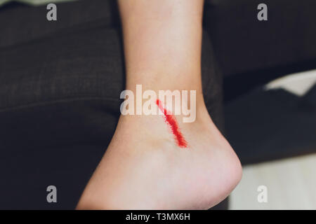 The leg is wound with bleeding caused by scratching Stock Photo - Alamy