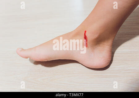 The leg is wound with bleeding caused by scratching Stock Photo - Alamy