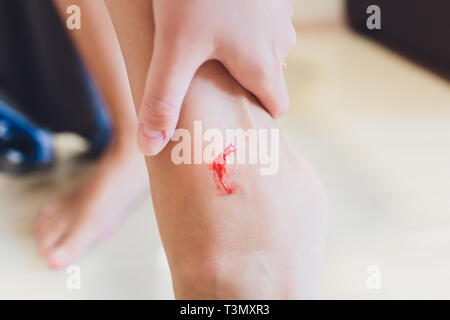 The leg is wound with bleeding caused by scratching Stock Photo - Alamy