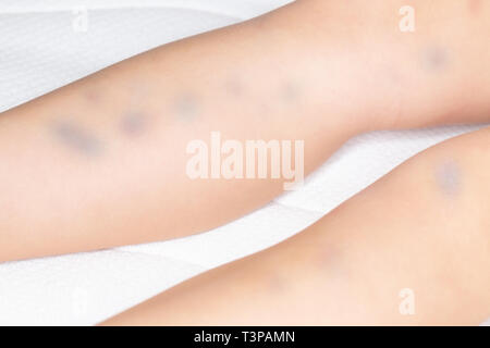Bruises on the leg of a small child Stock Photo - Alamy