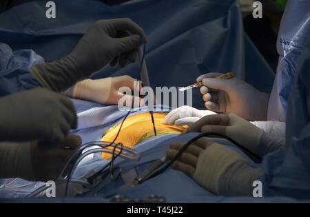 Lung cancer surgery. Incision in a patient's chest during a pulmonary ...