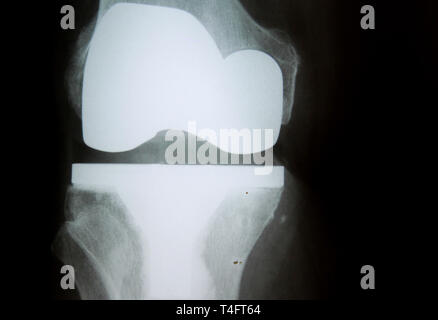 Knee prosthesis, knee endoprosthesis or knee joint prosthesis, on a ...