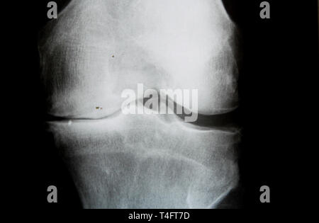 X-Ray image of knee joint with advanced arthrosis (Gonarthrose Stock ...