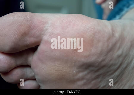 Closeup of foot with an infected wart. Foot bottom pathology: verruca ...