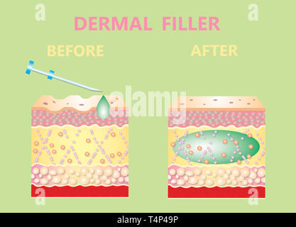 Illustration of an injection into the dermis of the skin Stock Photo ...