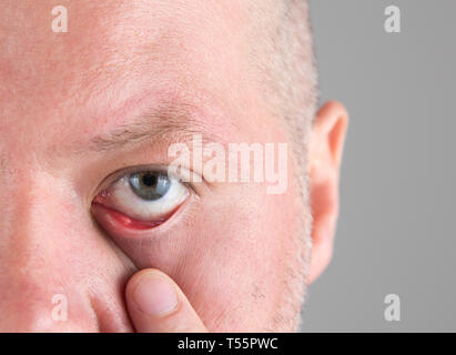 Meibomian abscess in the lower eyelid of an adult patient. The lump is ...