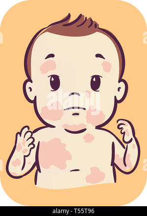Illustration of a Kid Boy with Rashes All Over His Body from Chickenpox ...