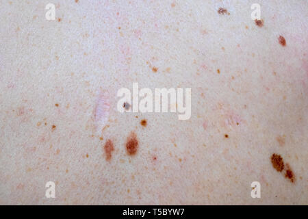 A melanocytic nevus also known as nevocytic , nevus-cell and commonly ...