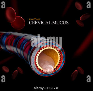 Bronchitis anatomy concept as an inflammation of bronchial tube lining ...