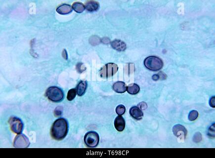 Histopathologic changes in histoplasmosis caused by Histoplasma ...