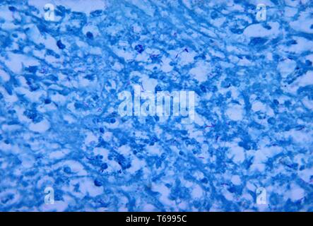 Photomicrograph of histopathologic changes in a case of botryomycosis ...